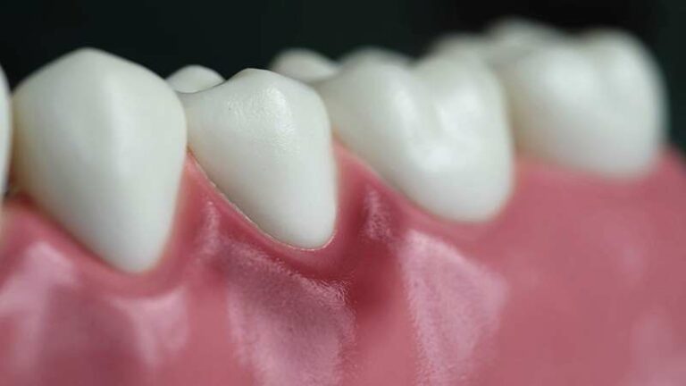 Recobrimento Radicular e Enxertos Gengivais - Clínica Vitruviana